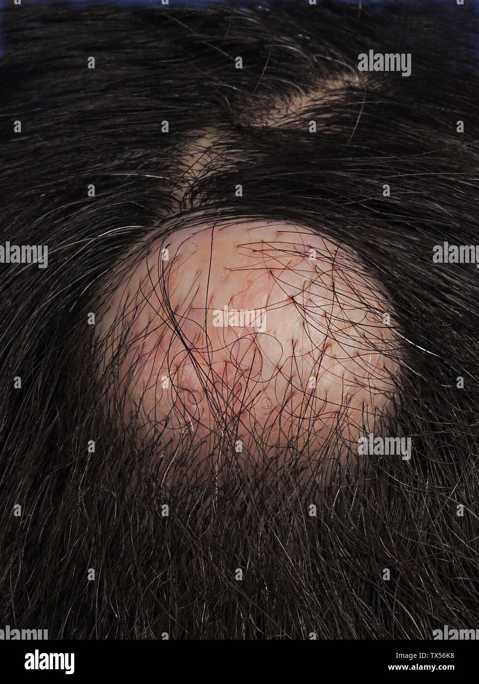 Pilar zyste -Fotos und -Bildmaterial in hoher Auflösung – Alamy