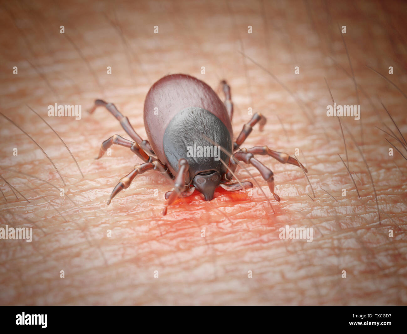 3D-gerenderte Abbildung: die Zecke in die menschliche Haut beißen ...