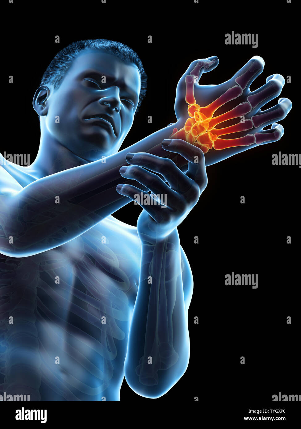 Rheuma finger illustration -Fotos und -Bildmaterial in hoher Auflösung ...