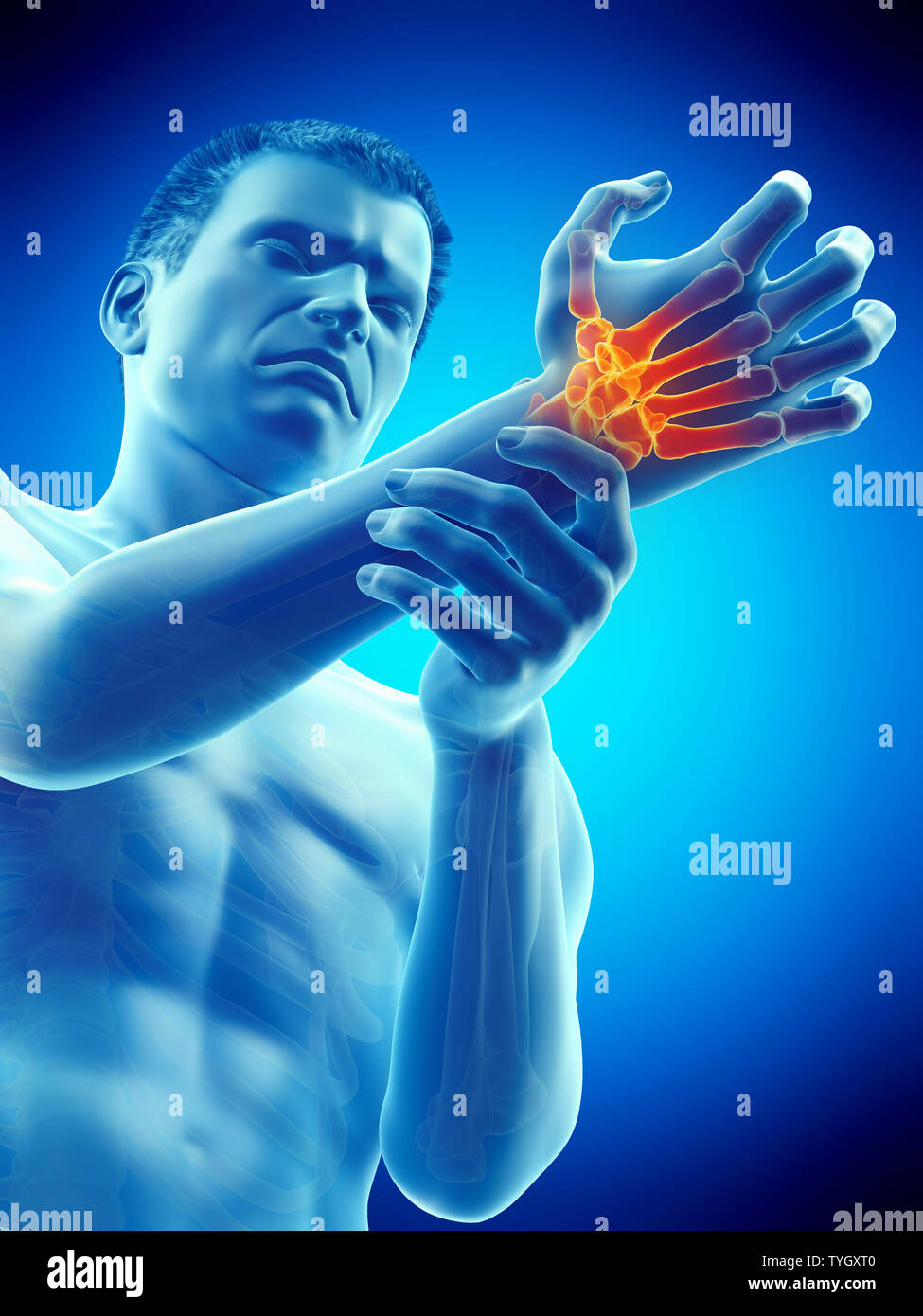 Rheuma finger illustration -Fotos und -Bildmaterial in hoher Auflösung ...