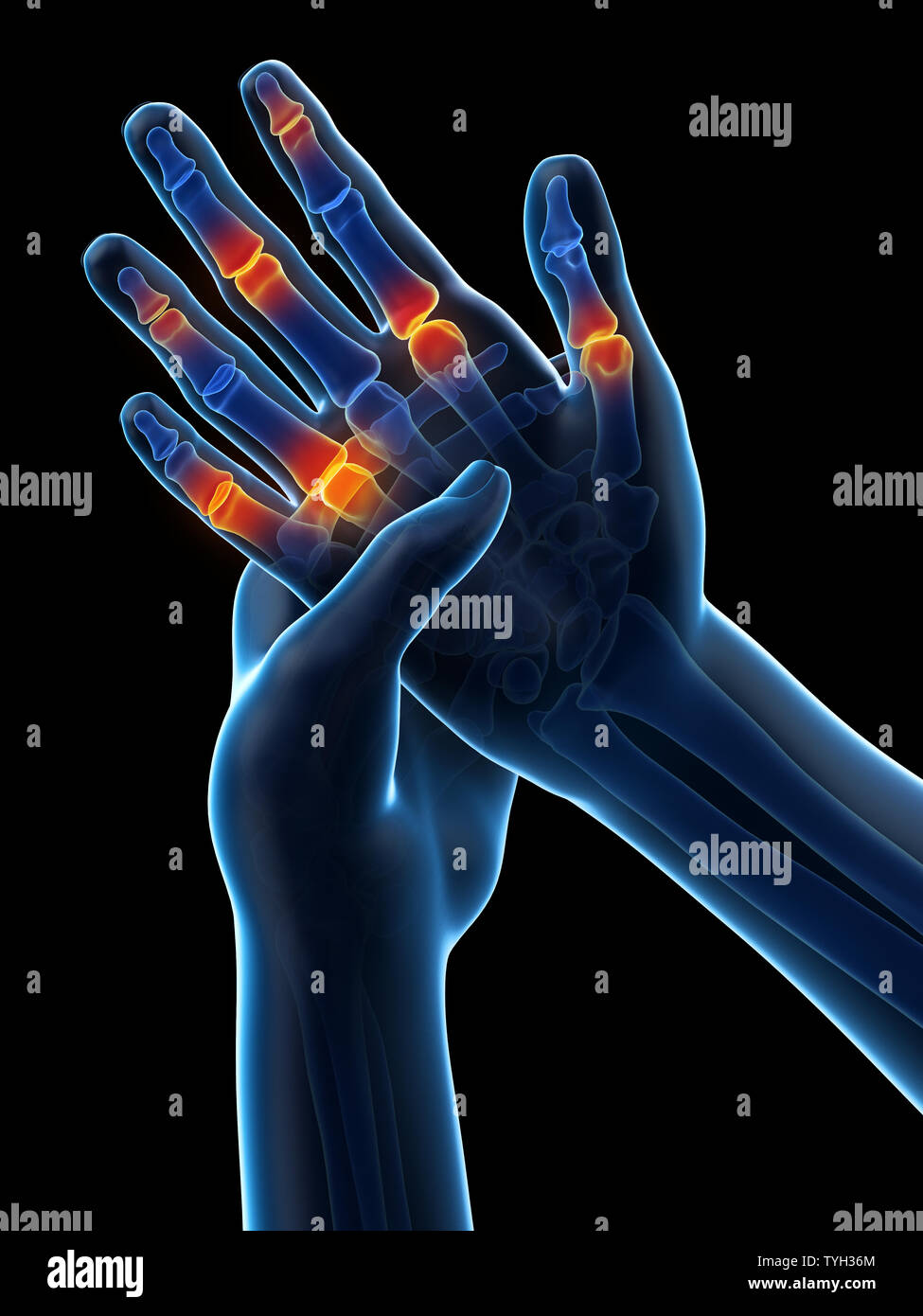Rheuma finger illustration -Fotos und -Bildmaterial in hoher Auflösung ...