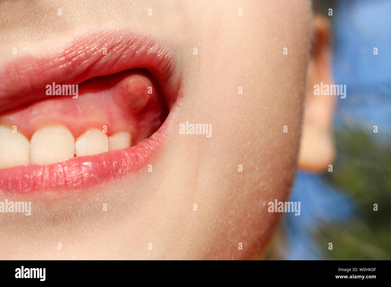 Wundes Zahnfleisch Stockfotos und -bilder Kaufen - Alamy