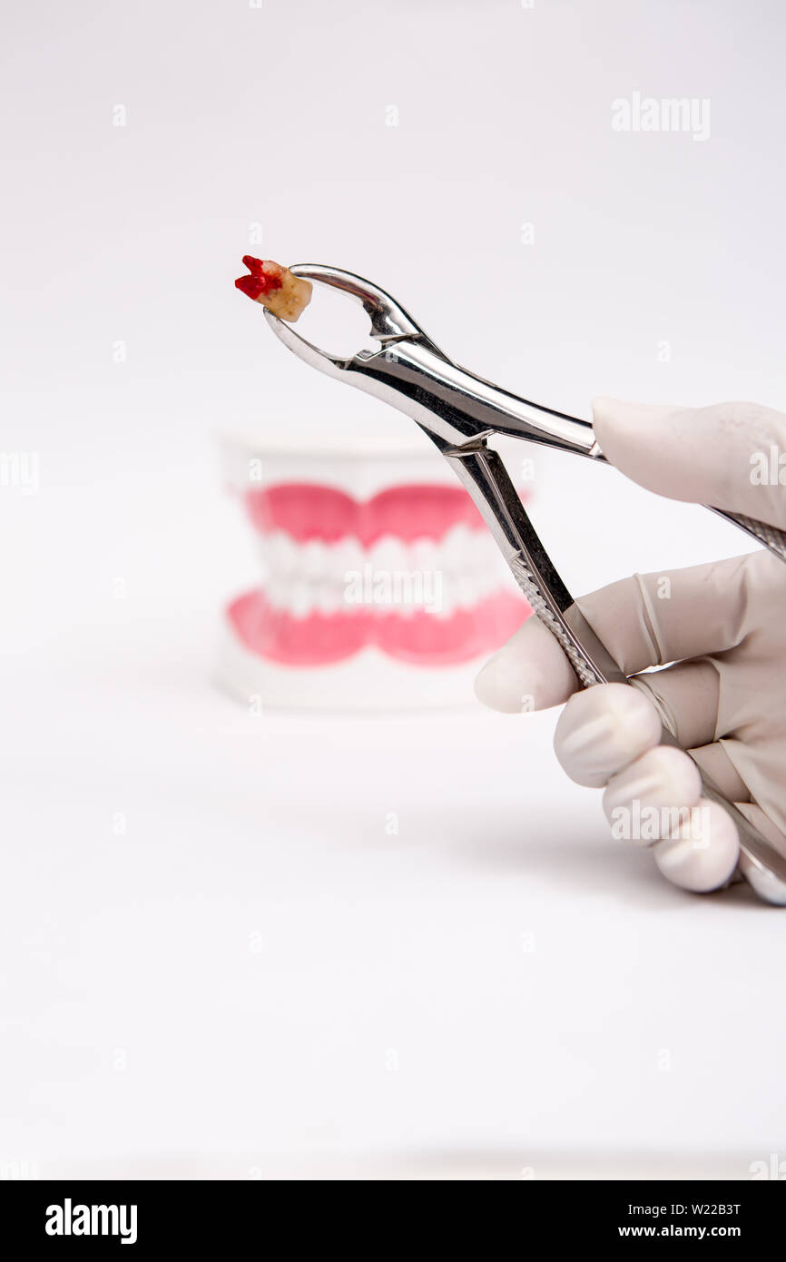 Dental Extraction Stockfotos und -bilder Kaufen - Alamy