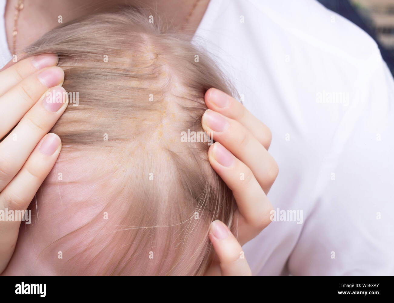 Seborrhoe kruste -Fotos und -Bildmaterial in hoher Auflösung – Alamy