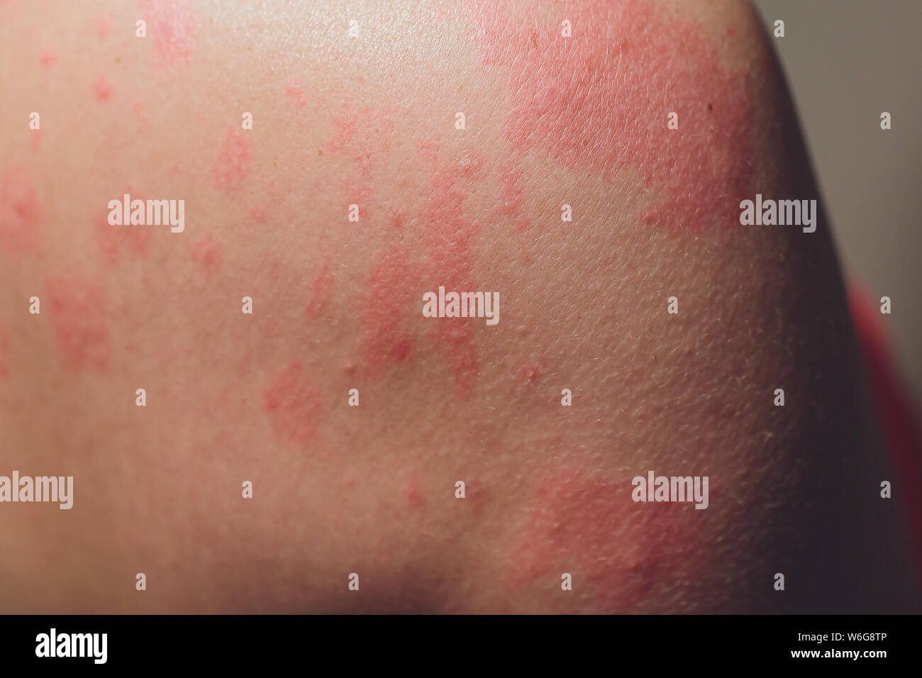 Postfructose Allergie Hautausschlag