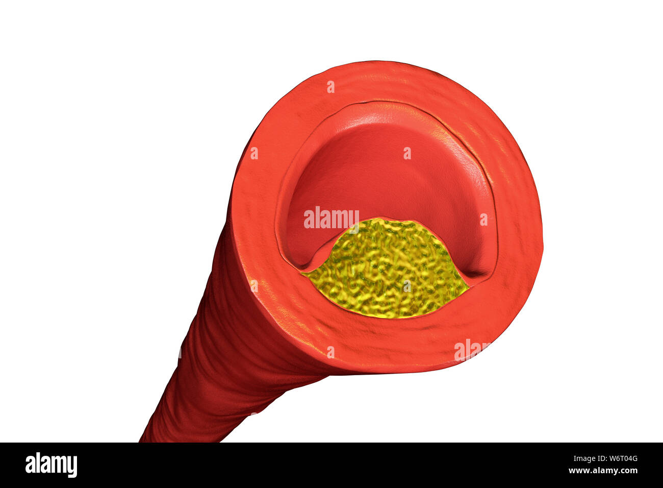 Artery blood plaque -Fotos und -Bildmaterial in hoher Auflösung – Alamy