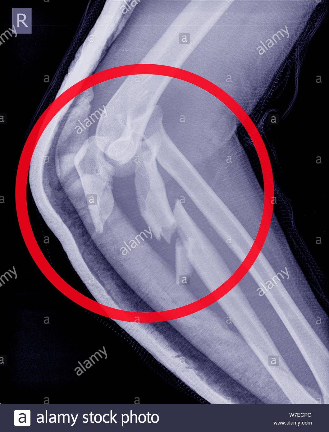 Gebrochener Ellbogen Stockfotos & Gebrochener Ellbogen Bilder - Alamy
