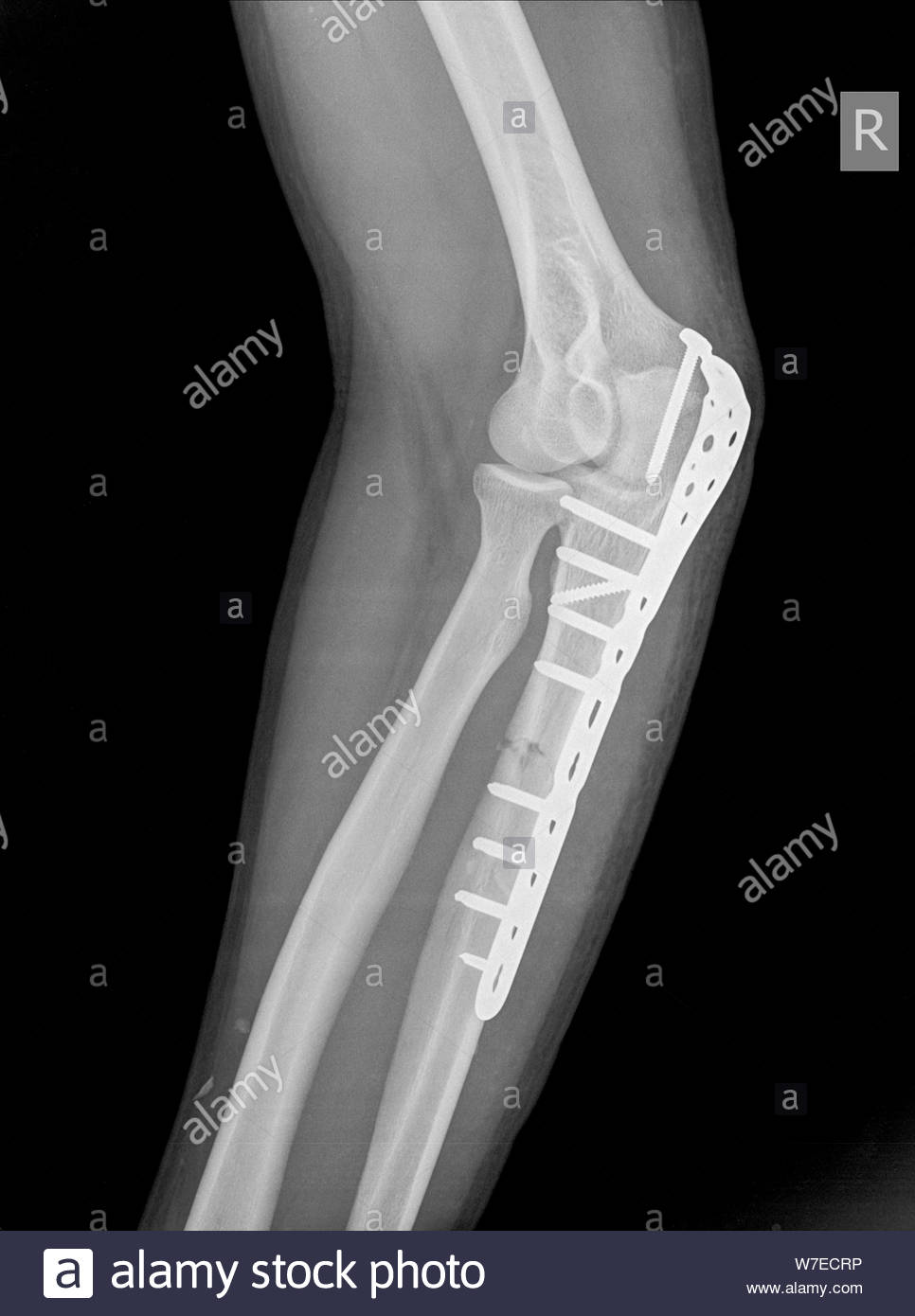 Gebrochener Ellbogen Stockfotos & Gebrochener Ellbogen Bilder - Alamy