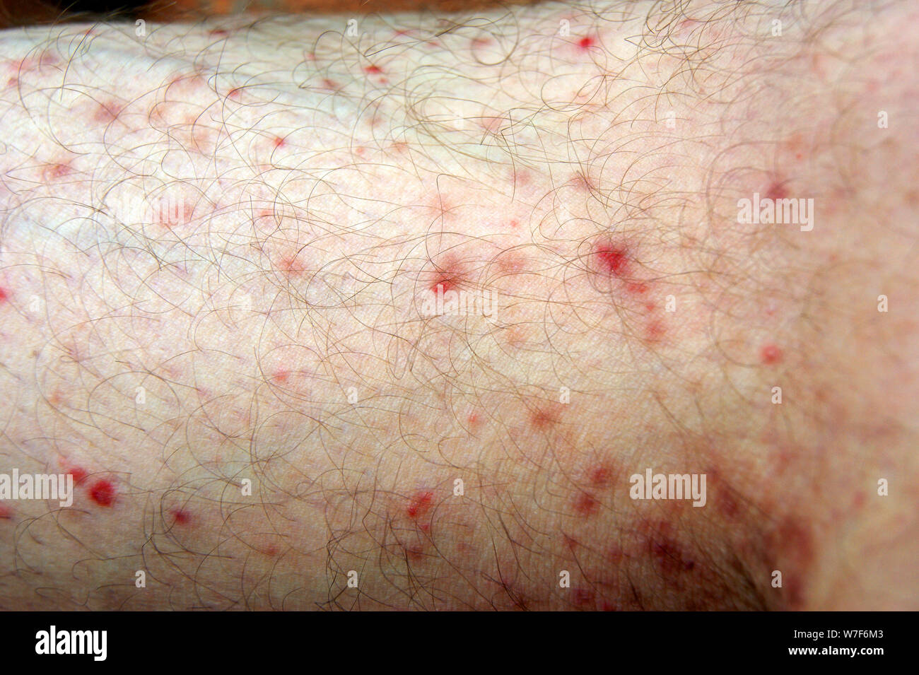 Ausschlag auf der Haut des Streckenabschnitts der Person ...