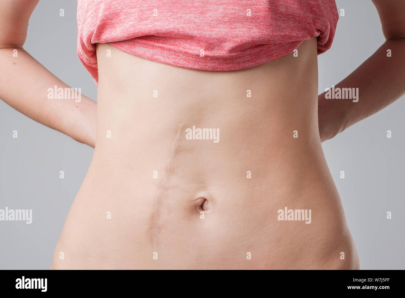 Narbe nach blinddarm operation -Fotos und -Bildmaterial in hoher Auflösung – Alamy
