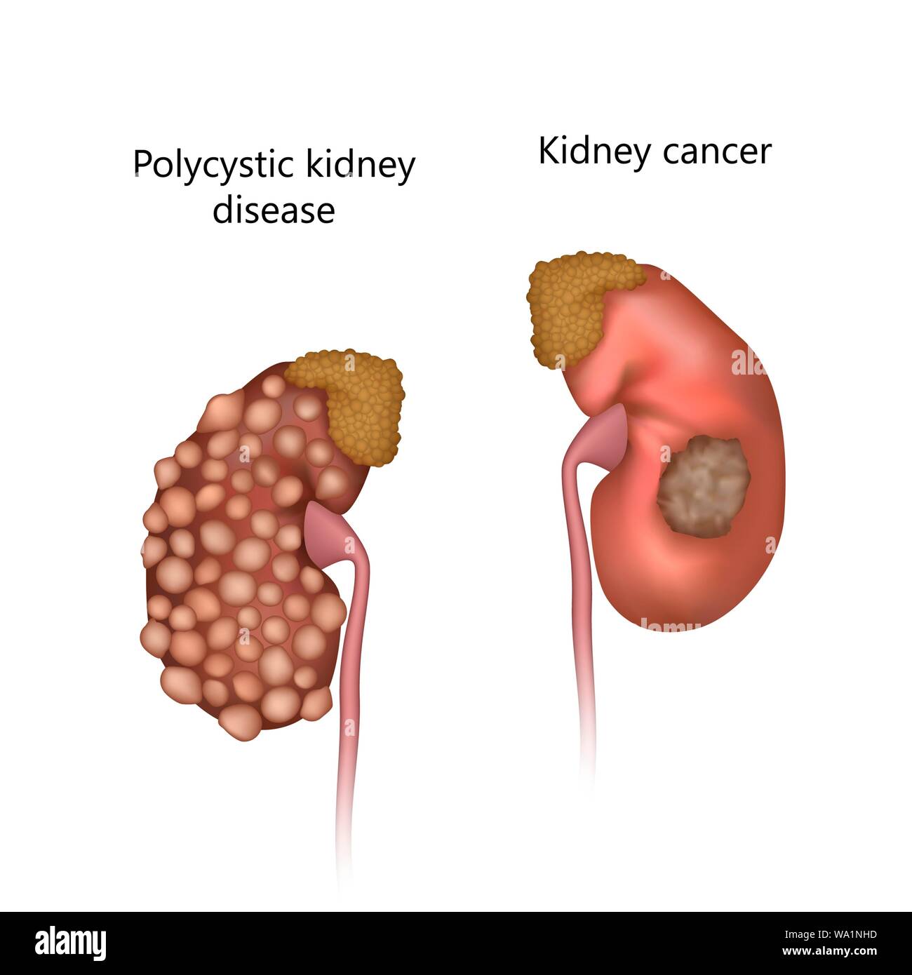 Histologie Der Polyzystischen Nierenerkrankung
