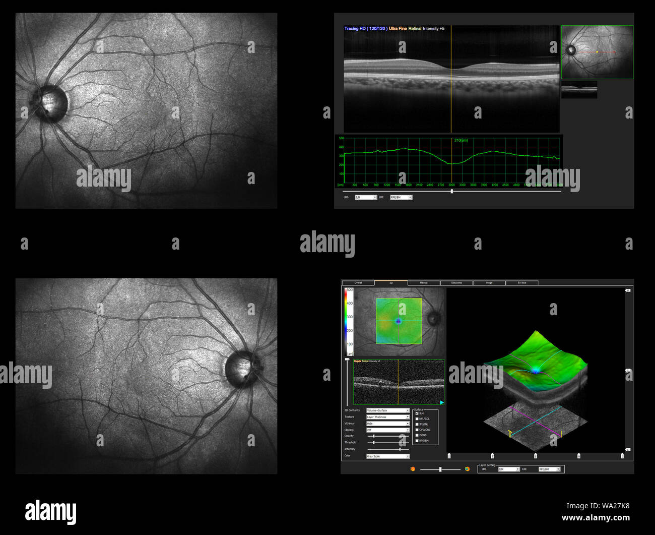 Fundus des auges -Fotos und -Bildmaterial in hoher Auflösung – Alamy