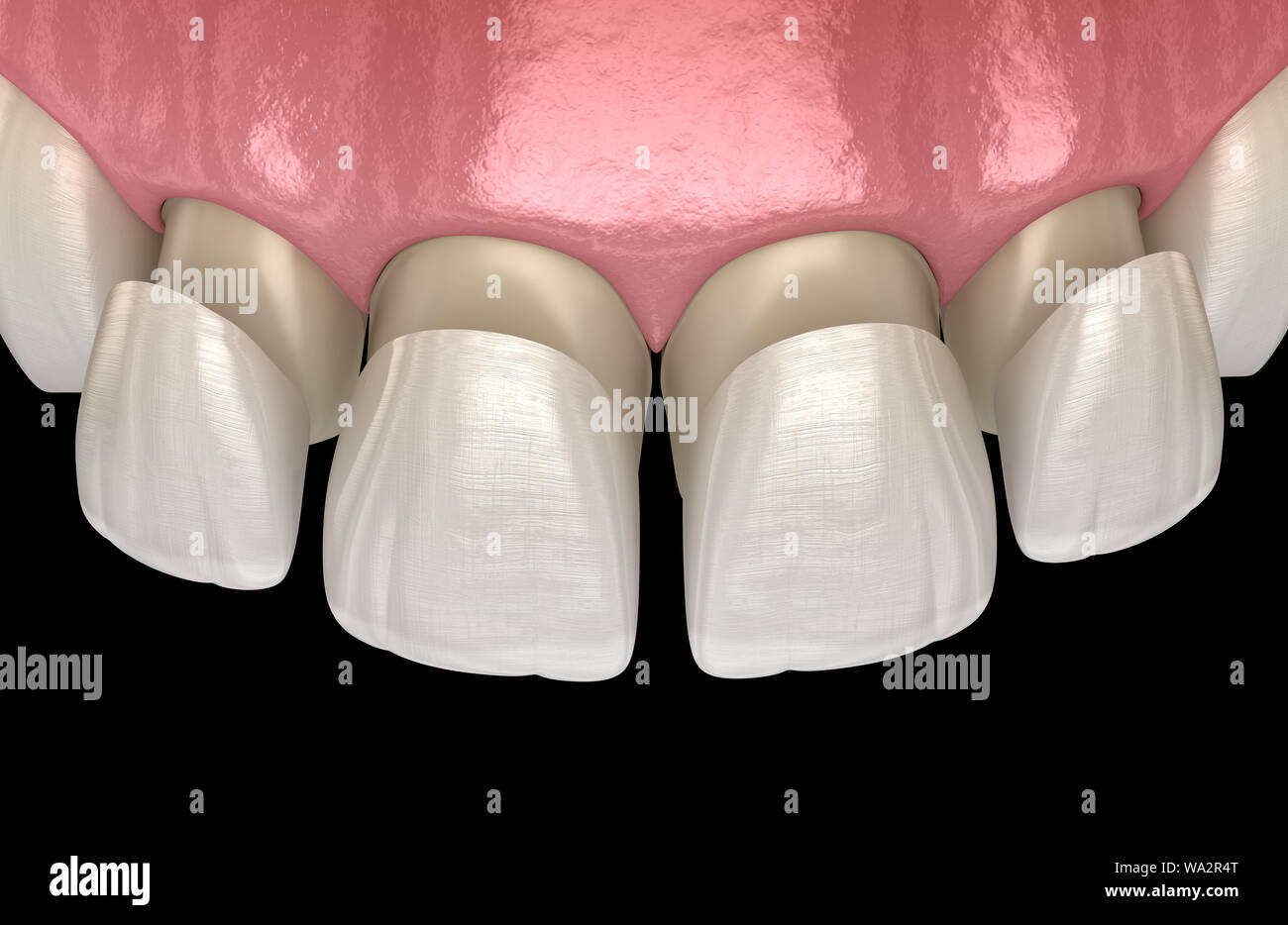 Lateral Incisor Stockfotos und -bilder Kaufen - Alamy