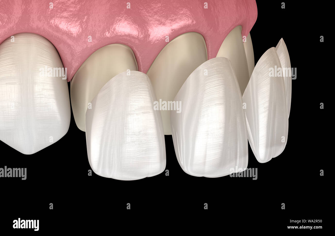 Lateral Incisor Stockfotos und -bilder Kaufen - Alamy