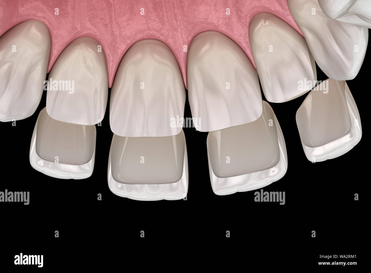 Lateral incisor -Fotos und -Bildmaterial in hoher Auflösung - Seite 2 ...