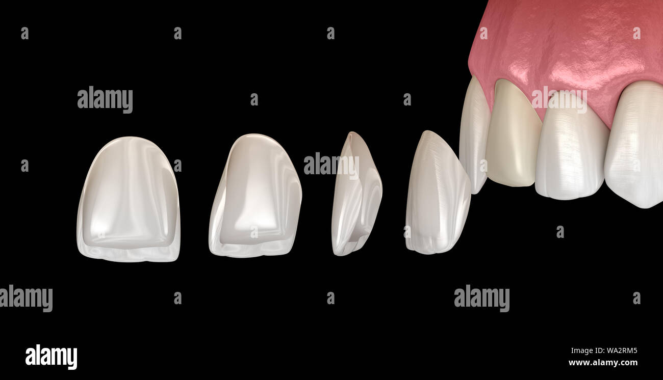 Lateral Incisor Stockfotos und -bilder Kaufen - Alamy