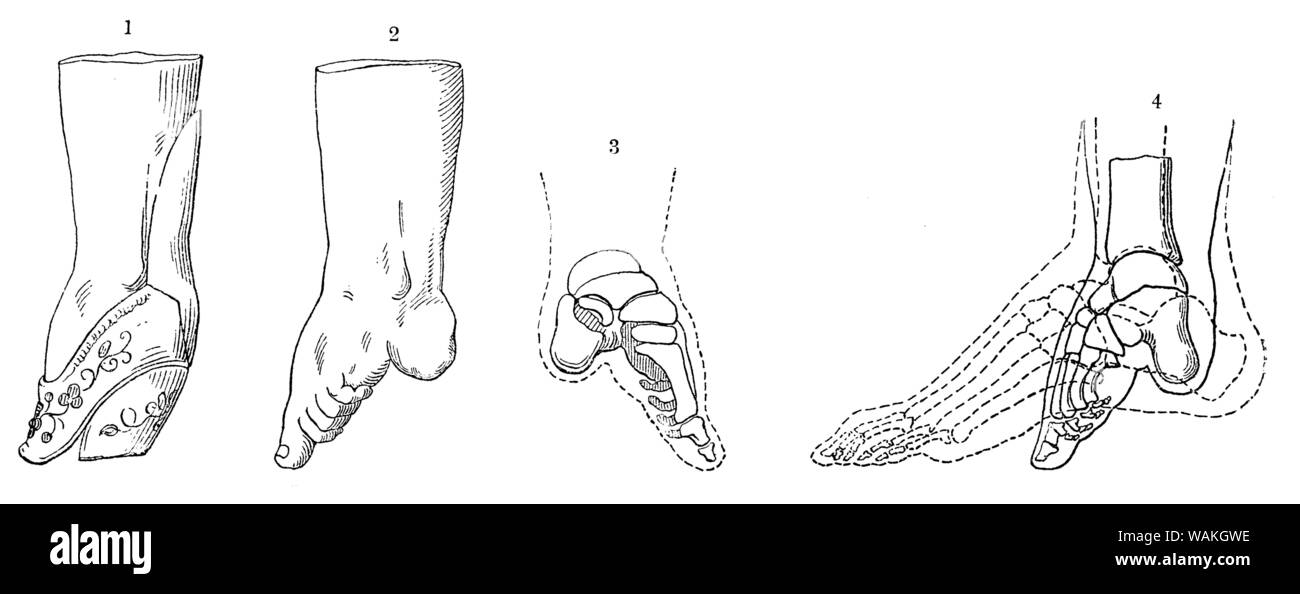 Verkrüppelte Füße Stockfotos & Verkrüppelte Füße Bilder - Alamy