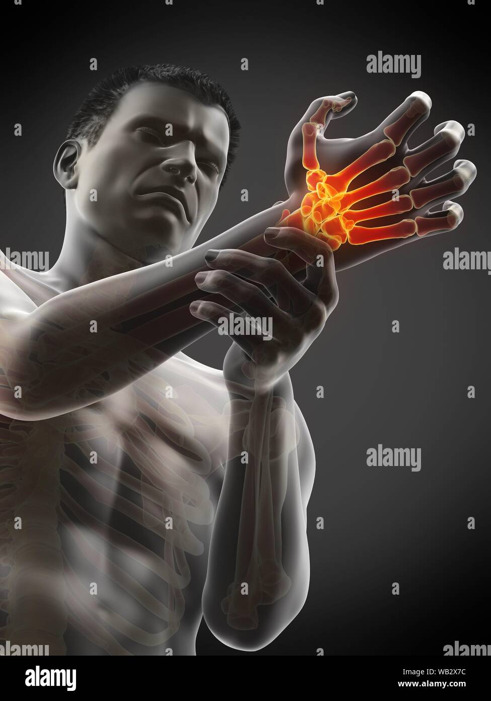 Rheuma finger illustration -Fotos und -Bildmaterial in hoher Auflösung ...