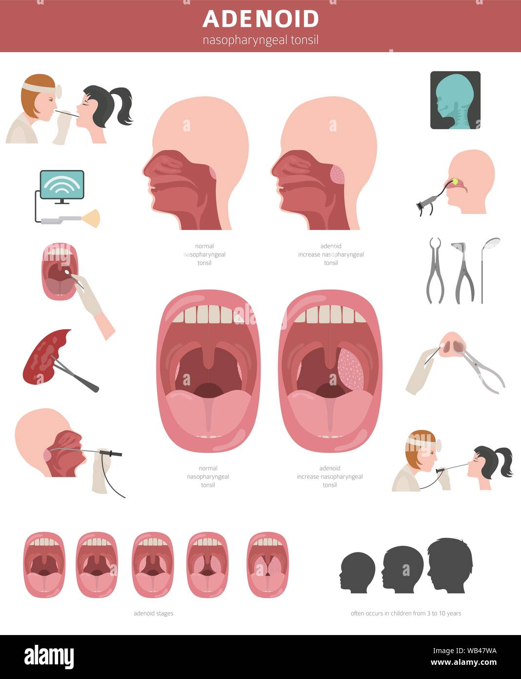 Nasen- und Rachenraum, nasenrachen Krankheiten. Adenoids Diagnose und ...