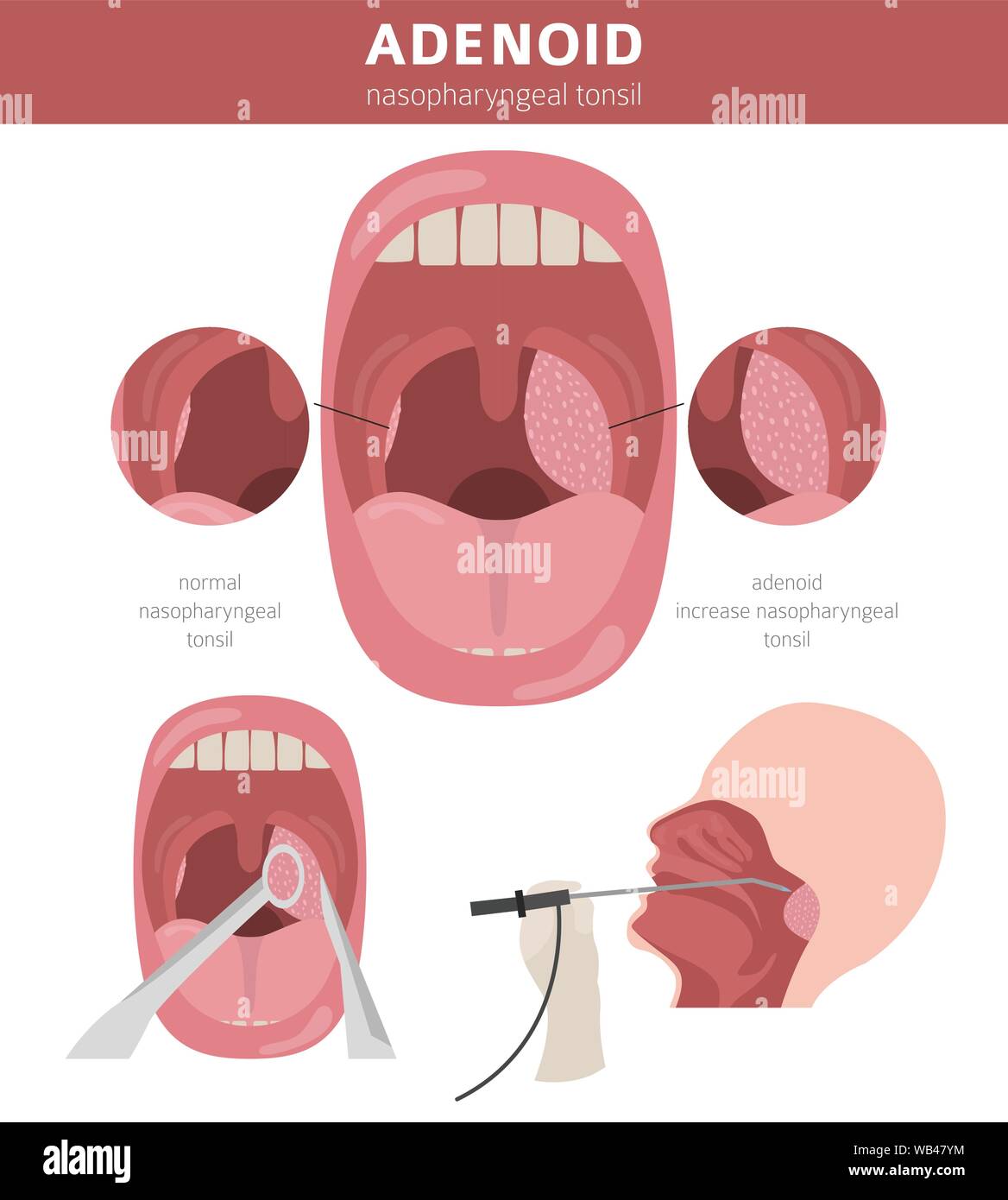 Nasen- und Rachenraum, nasenrachen Krankheiten. Adenoids Diagnose und ...
