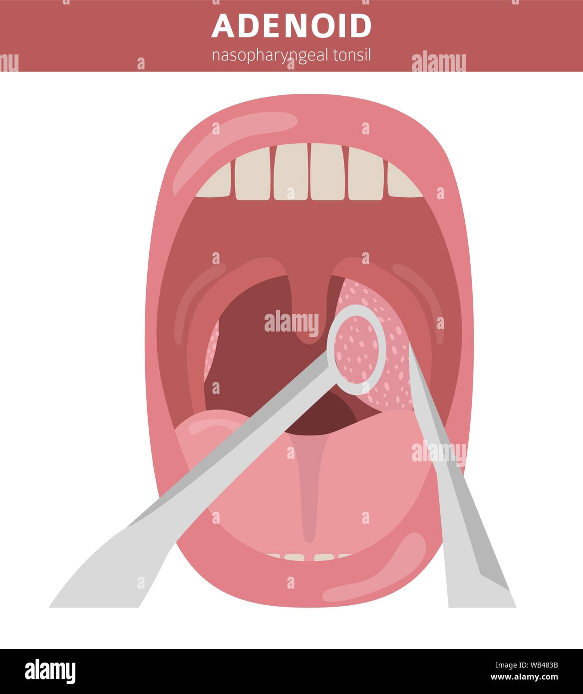 Nasen- und Rachenraum, nasenrachen Krankheiten. Adenoids Diagnose und ...