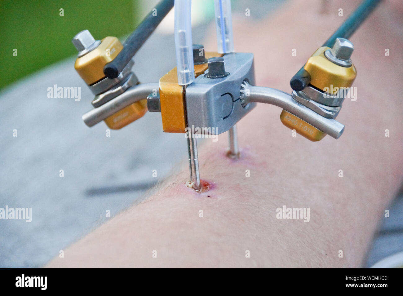 External fixation -Fotos und -Bildmaterial in hoher Auflösung – Alamy