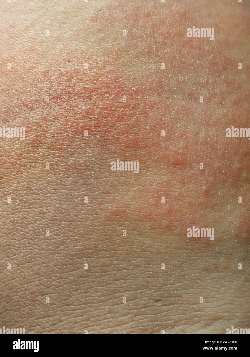 Allergic To Skin Stockfotos und -bilder Kaufen - Alamy