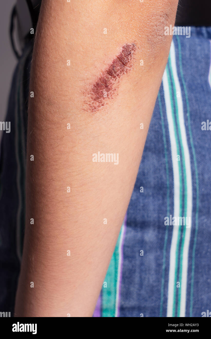 Wound treatment -Fotos und -Bildmaterial in hoher Auflösung – Alamy