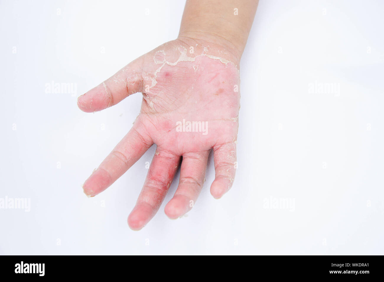 Ausschlag hand -Fotos und -Bildmaterial in hoher Auflösung – Alamy