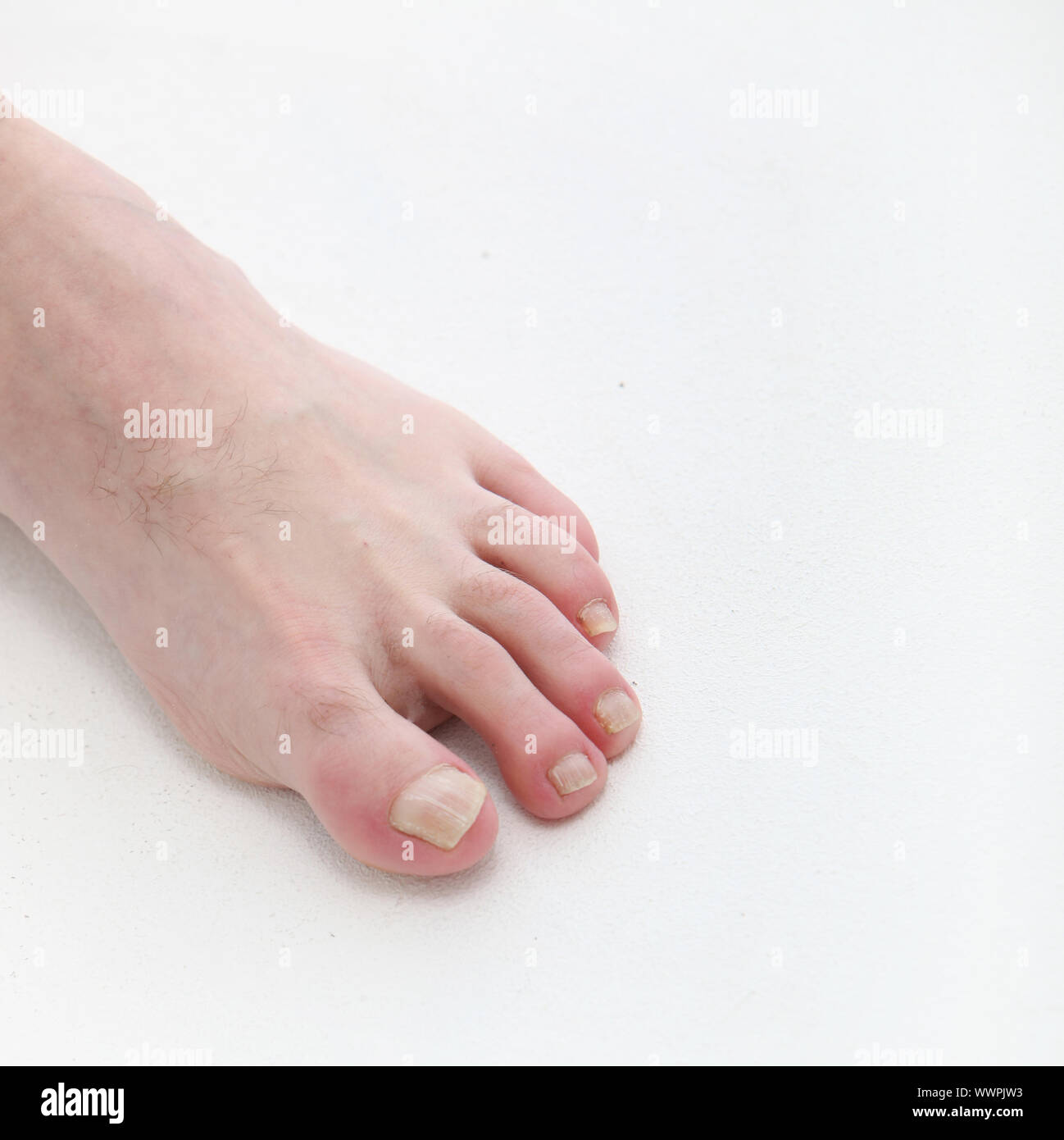 Psoriasis foot -Fotos und -Bildmaterial in hoher Auflösung – Alamy