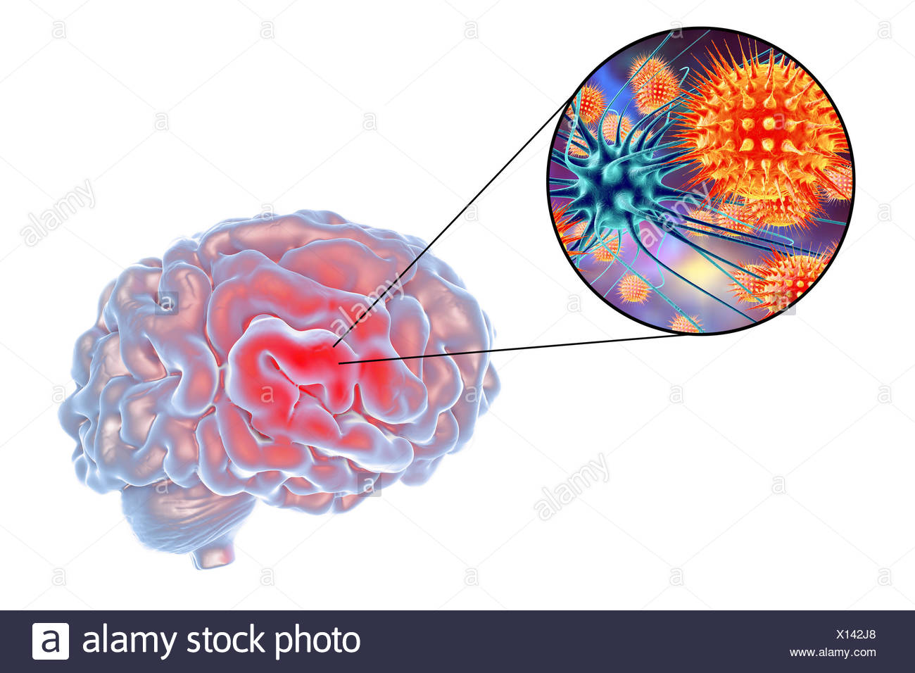 Encephalitis Brain Stockfotos und -bilder Kaufen - Alamy
