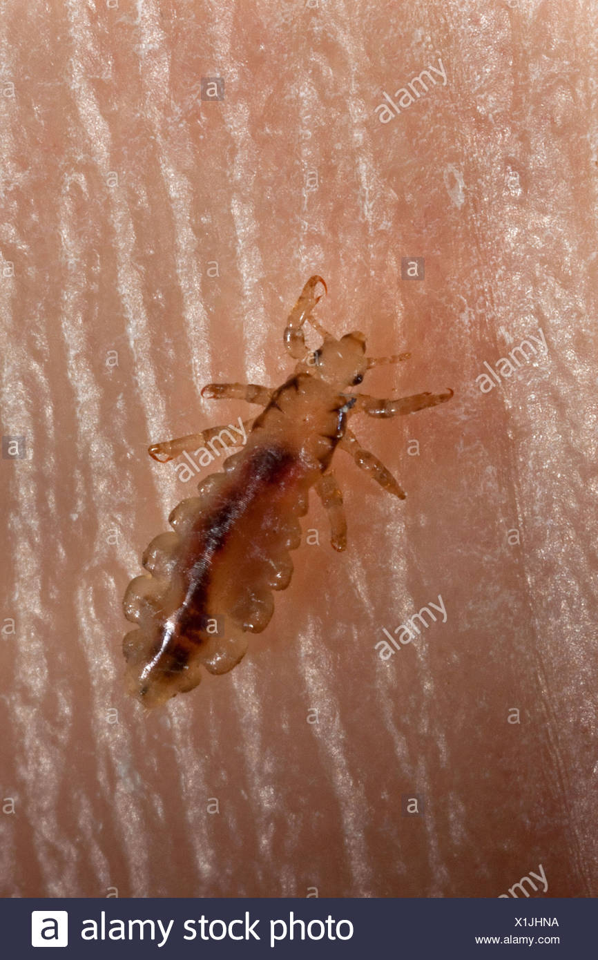 Pediculus Capitis Stockfotos und -bilder Kaufen - Alamy