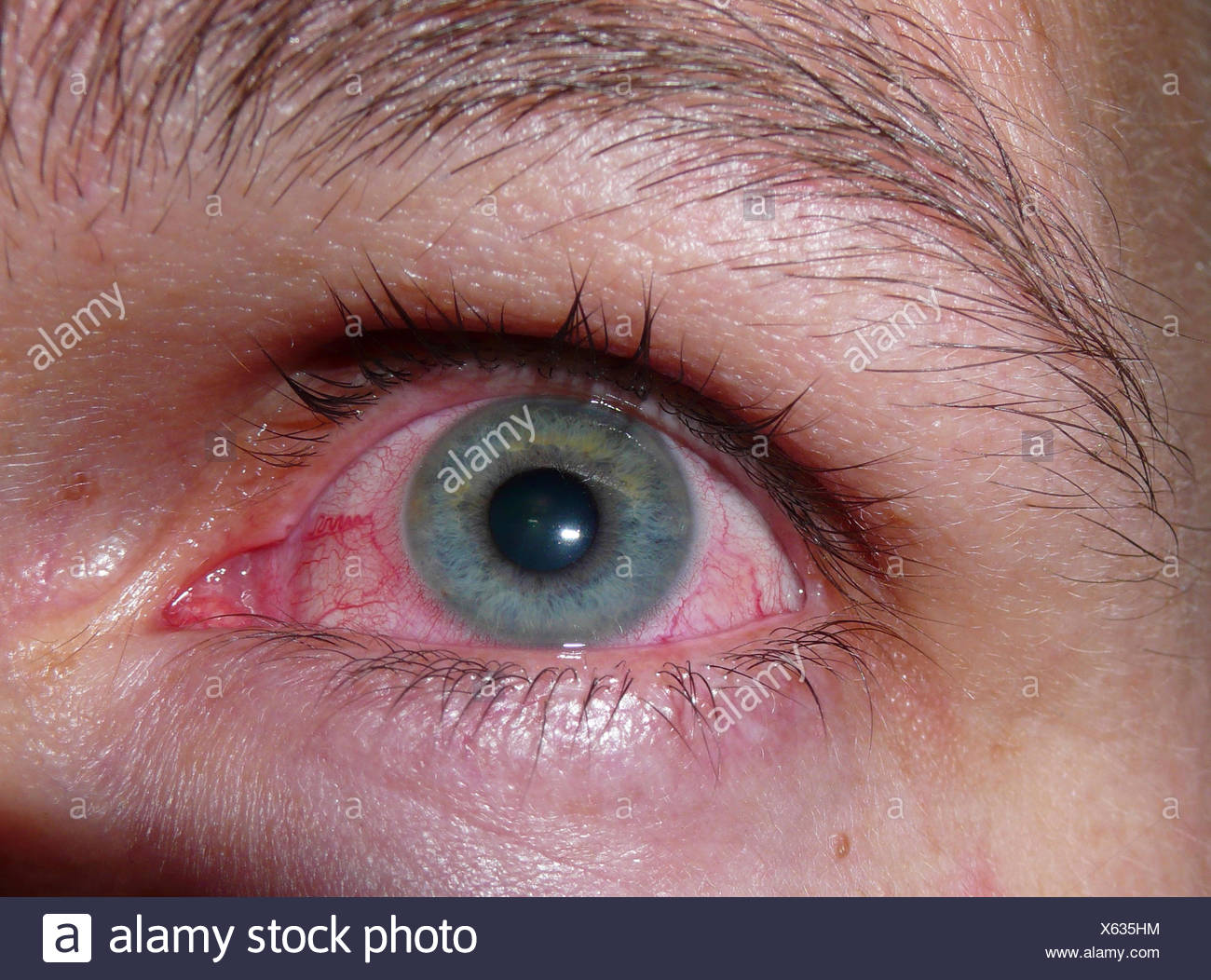 Schnupfen Im Auge