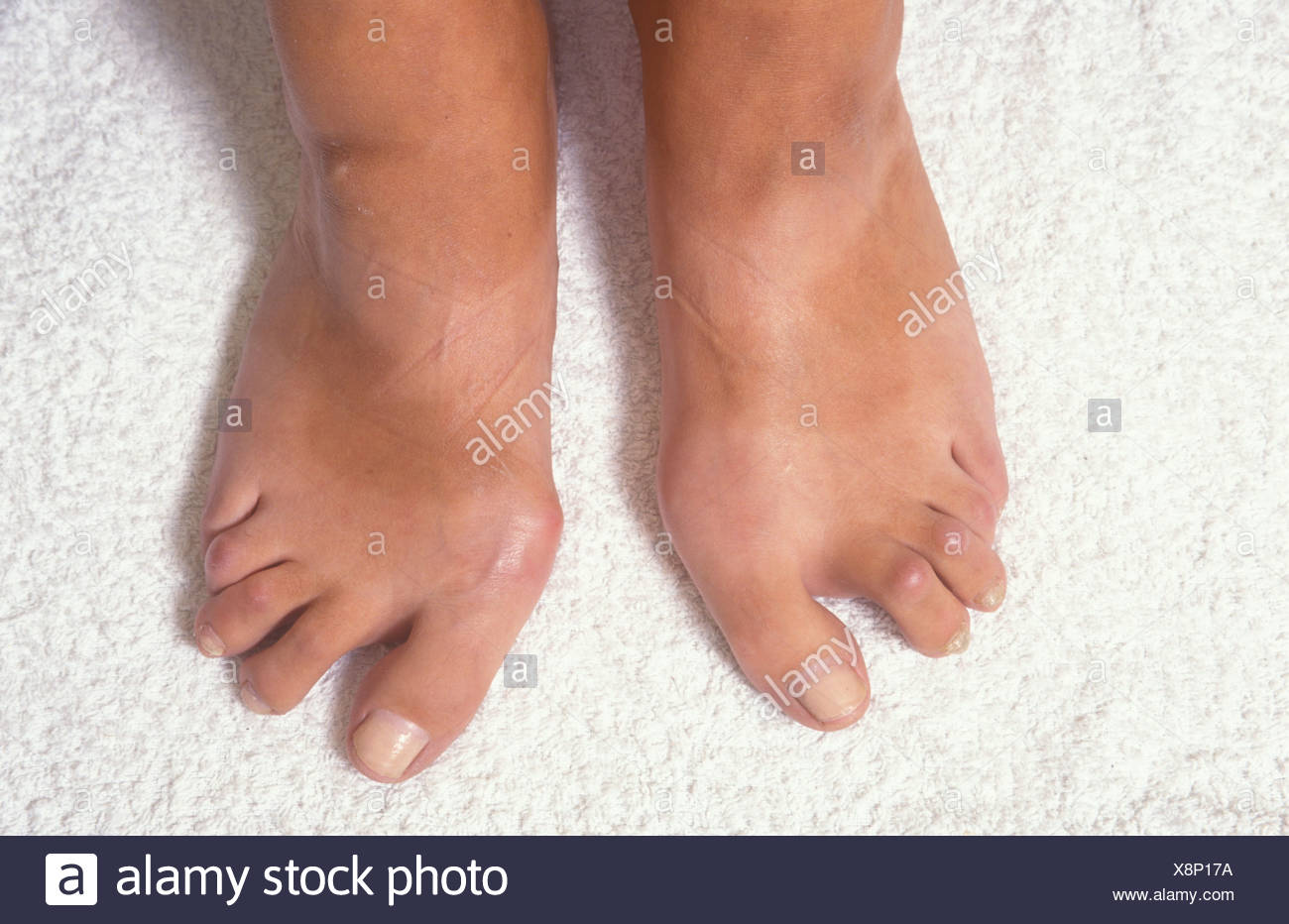 Deformierte Füße Stockfotos und -bilder Kaufen - Alamy