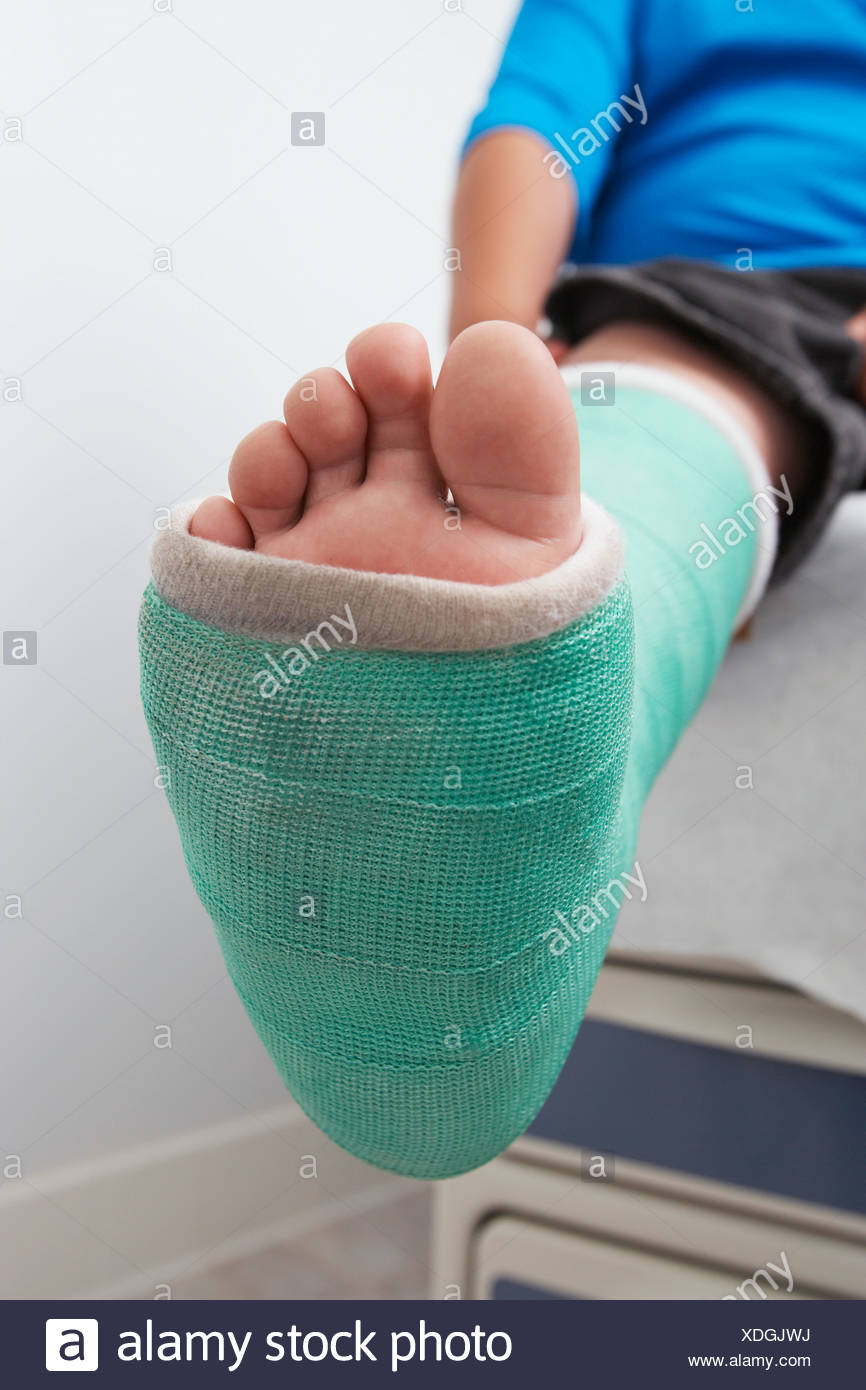 Bein Im Gipsverband Stockfotos und -bilder Kaufen - Alamy