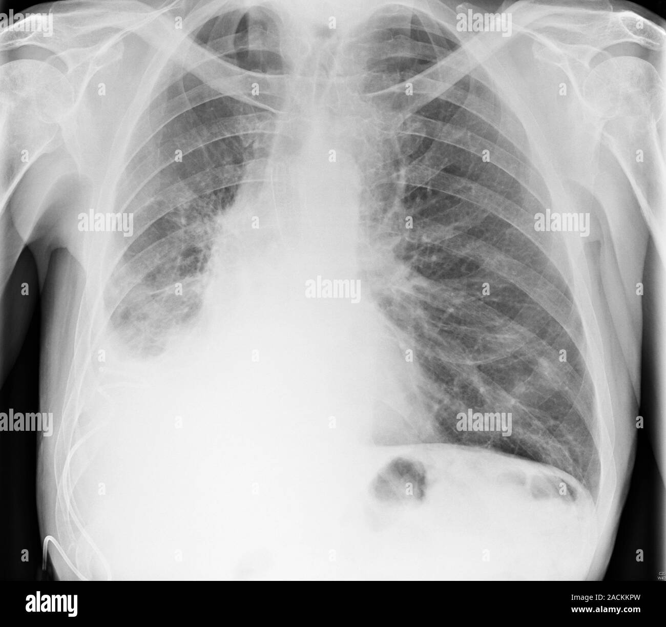 Radiografía De Tórax Derrame Pleural