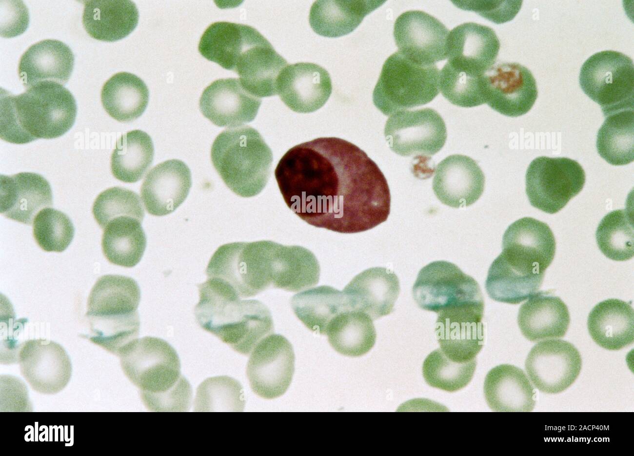 Gengivite De Celulas Plasmaticas