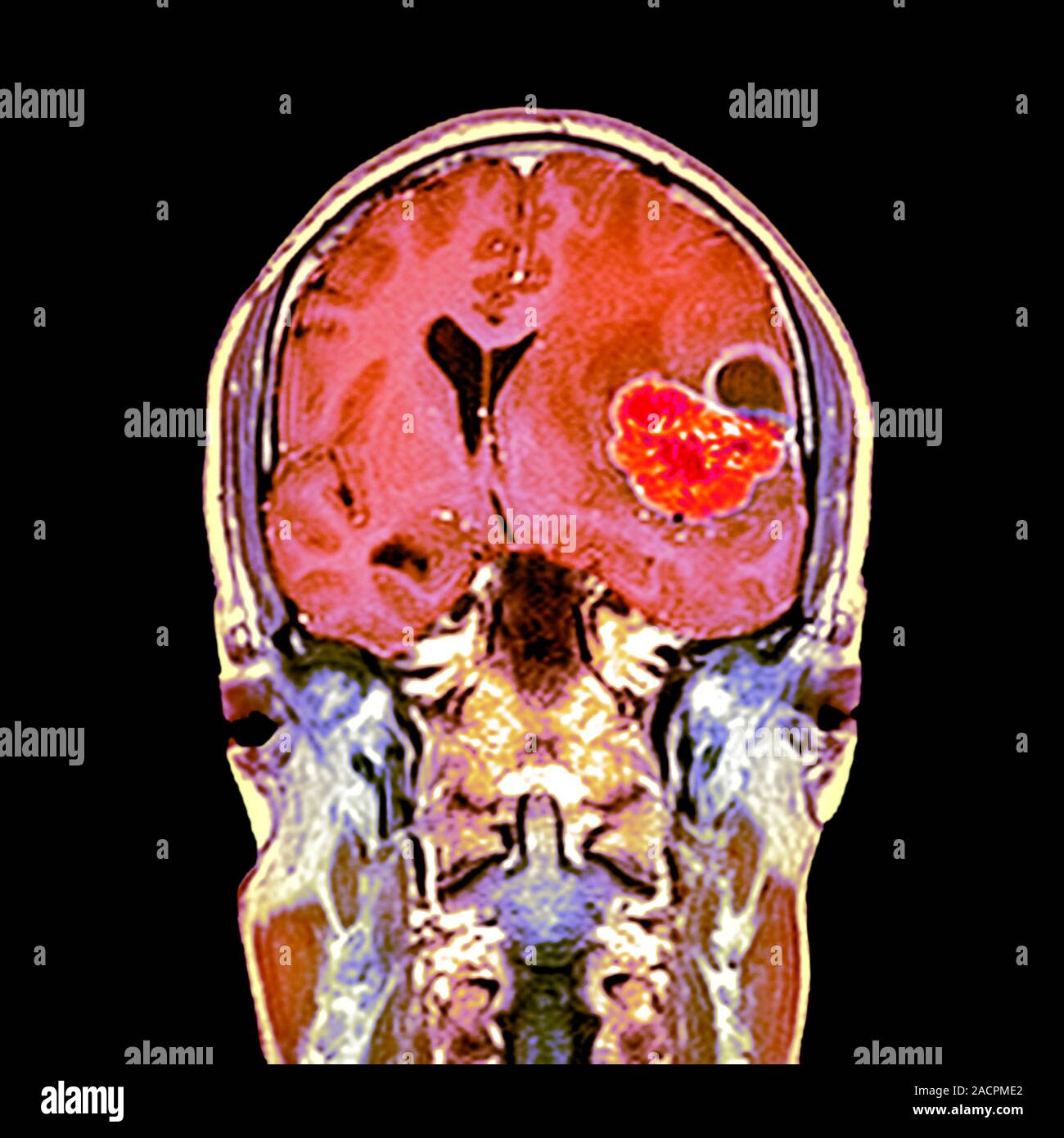 Fornice Cerebral Coronal