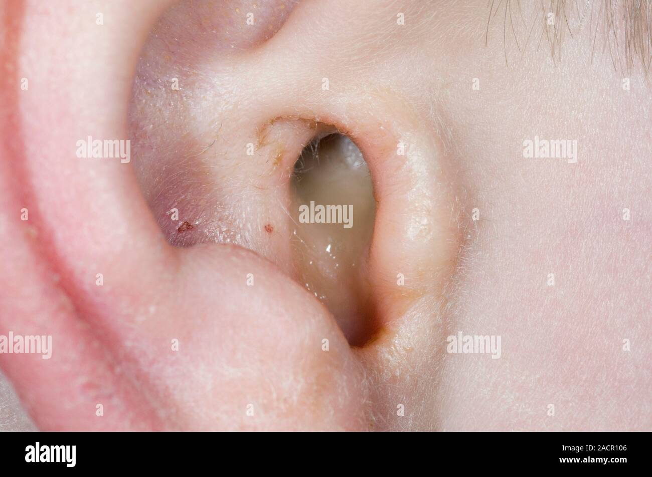 Recreación Rusia Gruñón timpano perforado cuidados Colaborar con otro ...