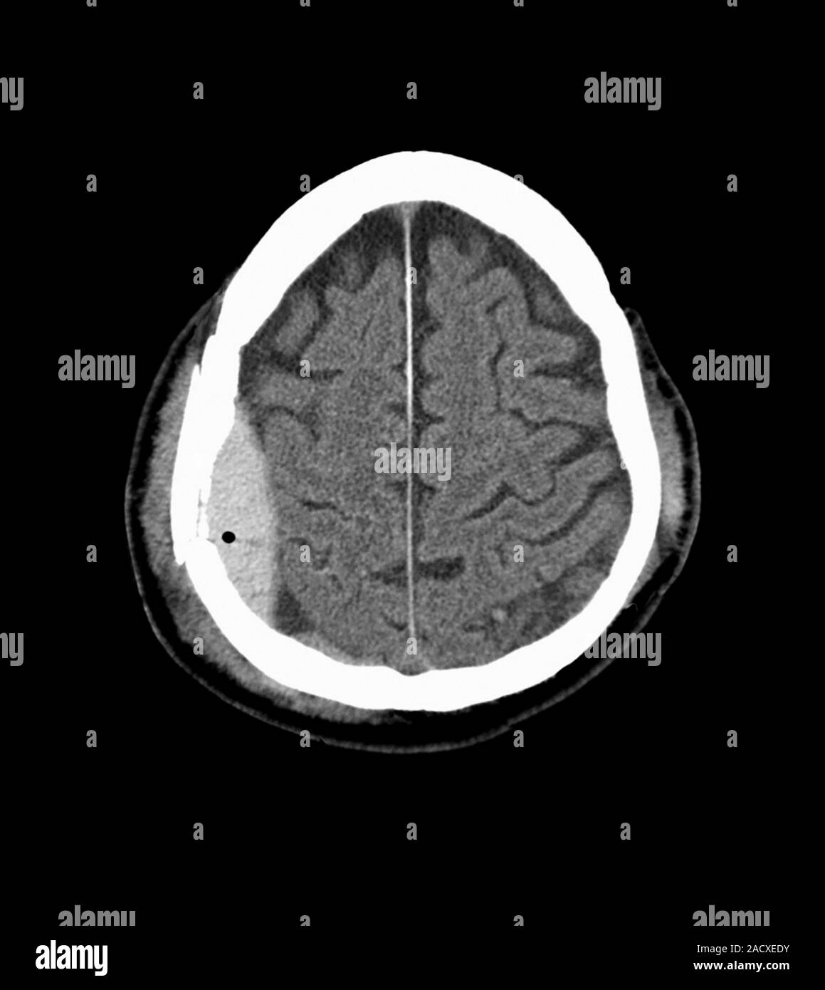 La Hemorragia Cerebral Tomografía Computarizada Ct De Un Hombre De