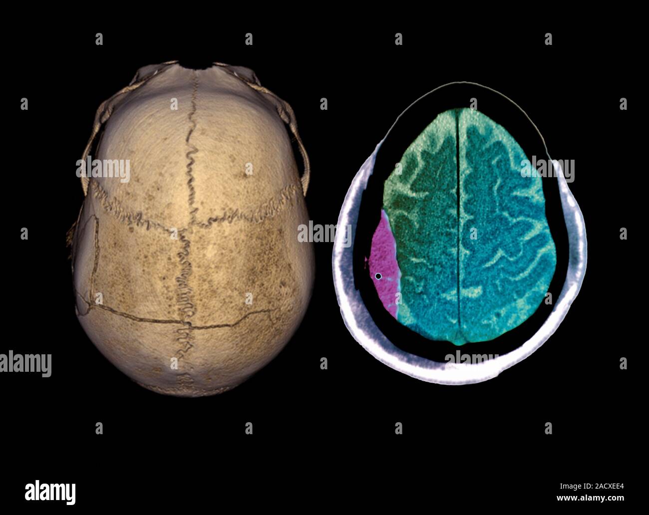 La Hemorragia Cerebral Tomografía Computarizada Ct De Un Hombre De