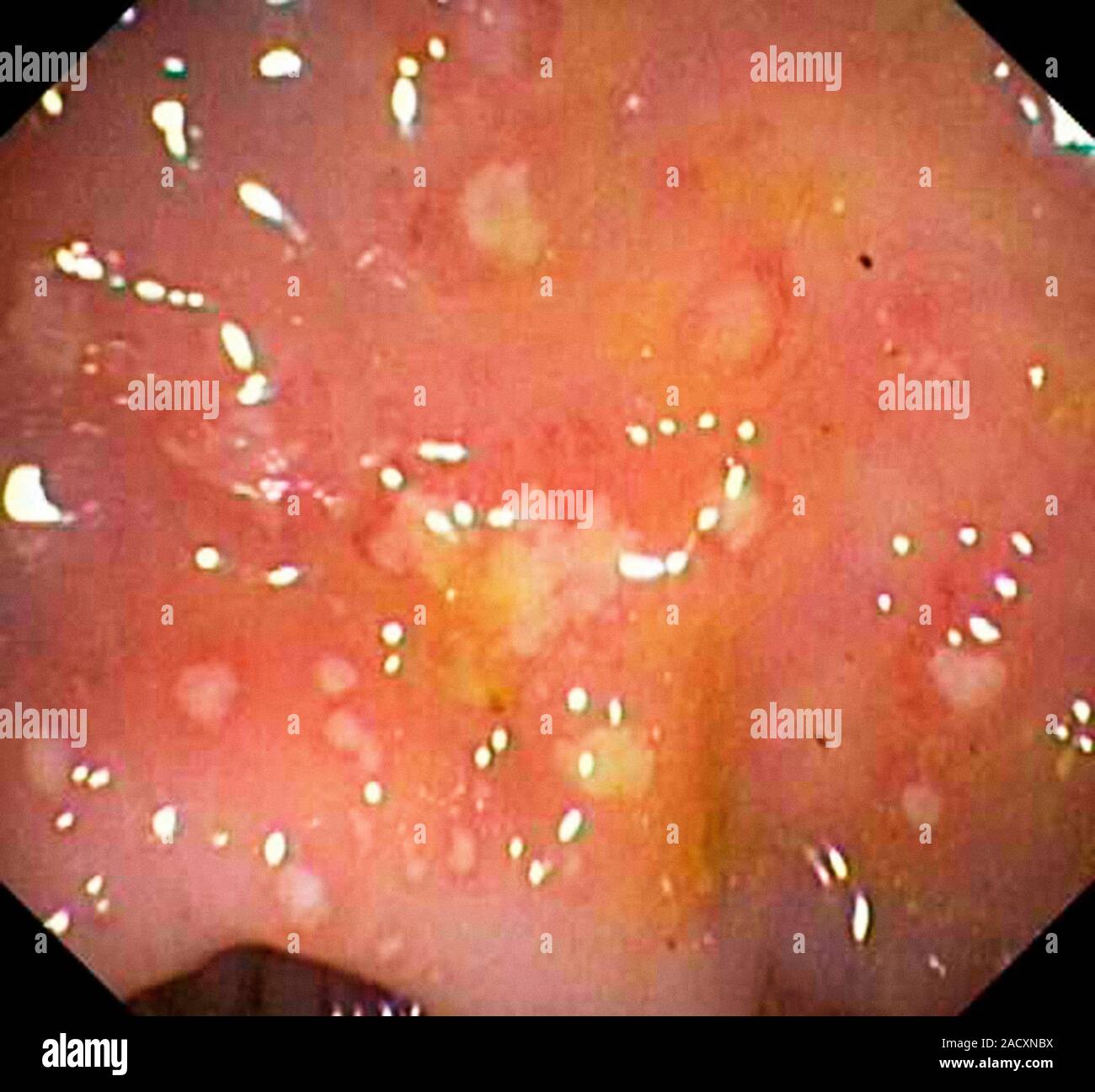 La Colitis Colonoscopio Endoscopio Vista De La Inflamación Del Colon Intestino Grueso