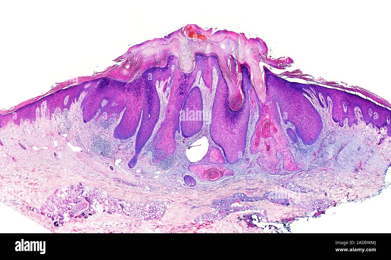 Microscopía De Luz El Carcinoma De Células Escamosas De La Piel