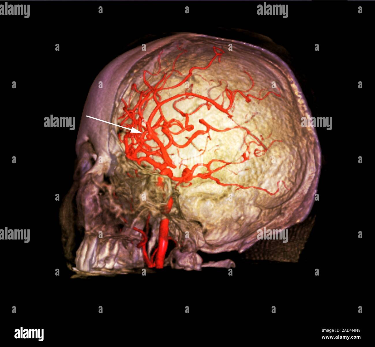 La Hemorragia Cerebral 3d Color Tomografía Computarizada Ct