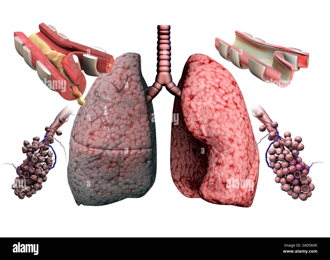 Enfermedad Pulmonar Obstructiva Crónica Ilustración Que Muestra Los