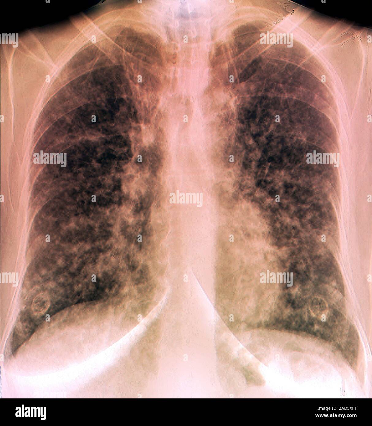 Cáncer De Pulmón Terminal Frontal De Color De Rayos X Del Pecho De Una Mujer De 48 Años Con