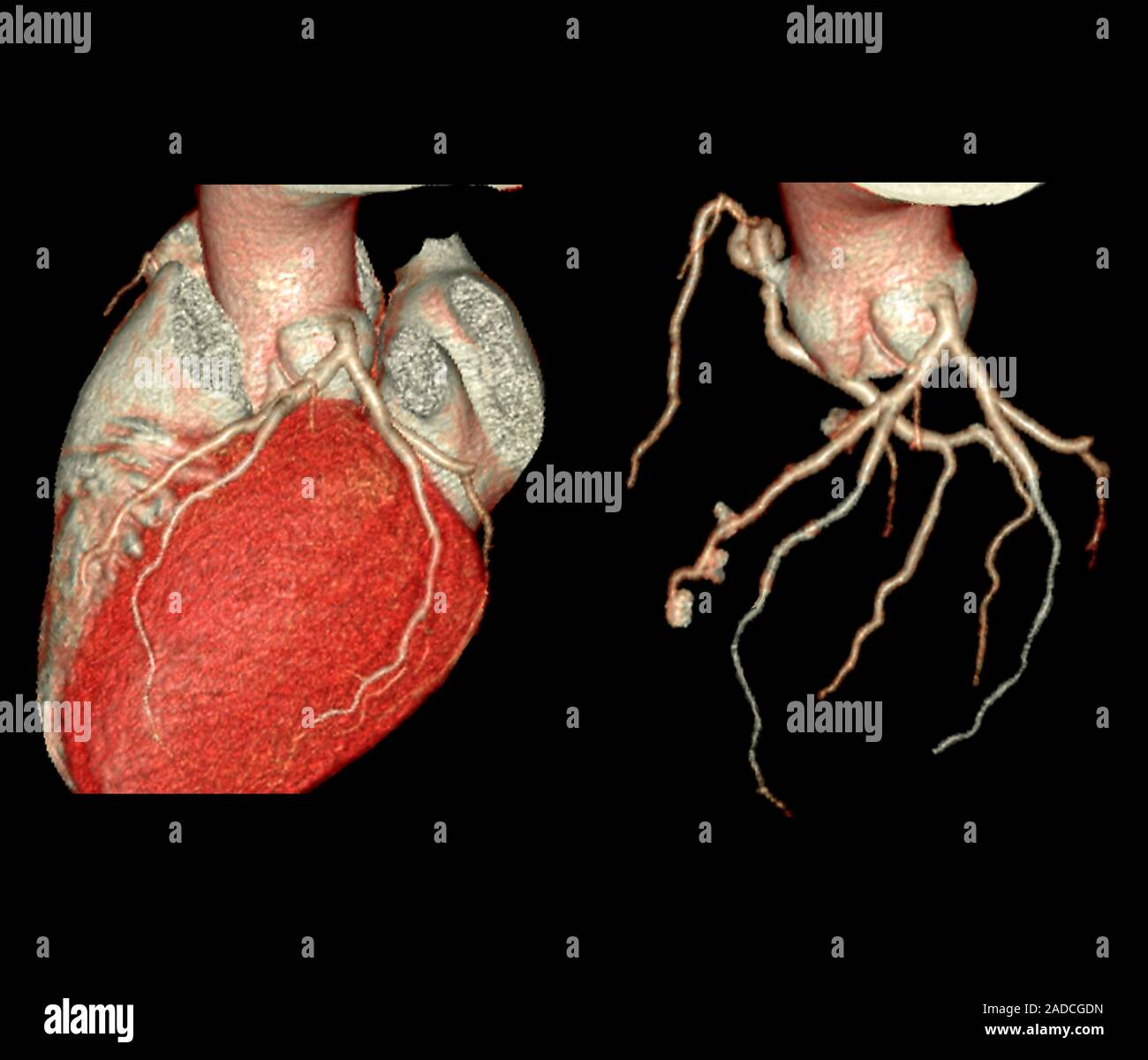 El corazón y la evaluación de la arteria coronaria. 3D color tomografía ...