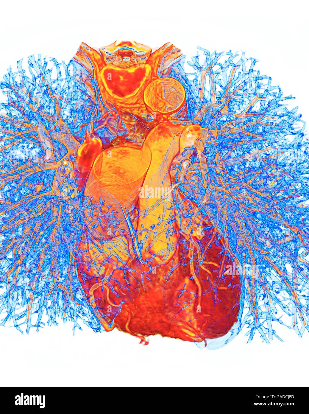 Corazón y Pulmón bronquiolos frontal de color 3D, tomografía axial ...