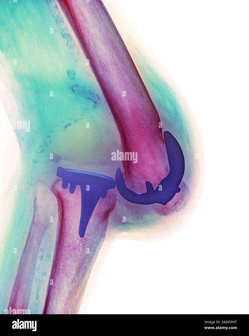 Dislocación de la rodilla. Radiografía de la dislocación de la rodilla ... Dislocación de la rodilla. Radiografía de la dislocación de la rodilla ...