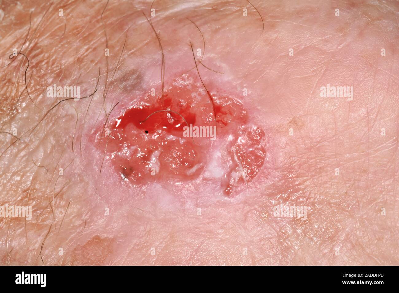 El Carcinoma De Células Basales En El Dorso De La Mano De Un Varón De